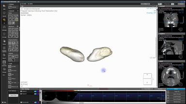 Trapped Canines Segmentation inducing Root Resorption