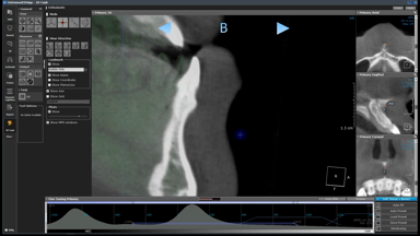 [Prognathism case] SNA,SNB & ANB Landmarks