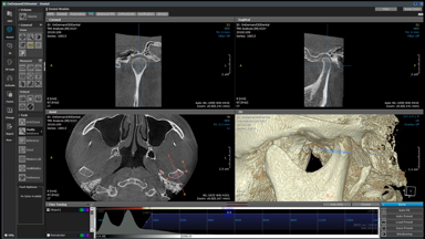TMJ Analysis (Open & Close view)