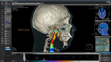 Airway analysis. (Obstructive Sleep Apnea)