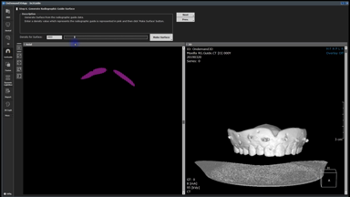 Full Edentulous Mandible-Stent Generation