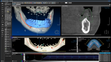 Full Edentulous Mandible-Implant Placement