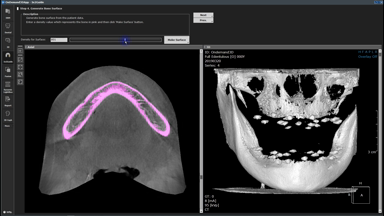 Full Edentulous Maxilla-Stent Generation