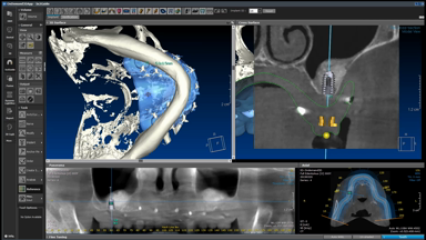 Full Edentulous Maxilla-Implant Placement