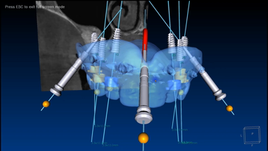 Full Edentulous Maxilla.MiniClip