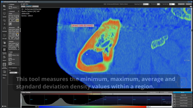 Dynamic Lightbox(Stafne Defect)case